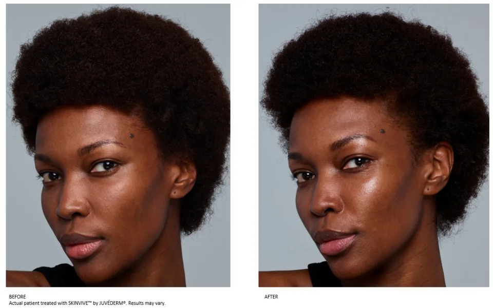 Faces of South Tampa | Juvéderm SKINVIVE Tampa | SKINVIVE microdroplet ...